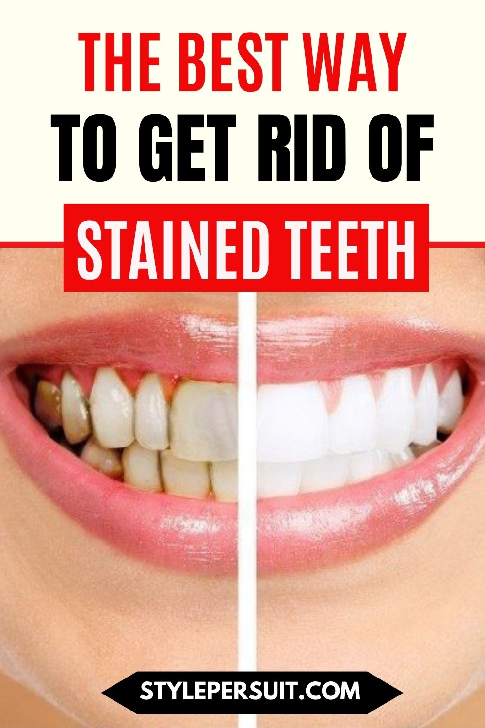 Stained Teeth: Understanding Types, Causes, and Treatments - StylePersuit