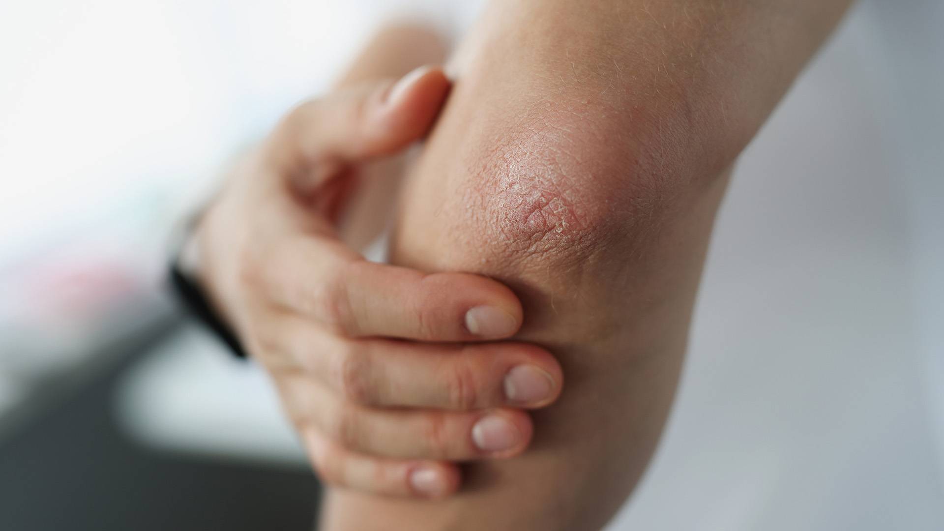 10 Zinc Deficiency Symptoms You Need to Know - StylePersuit